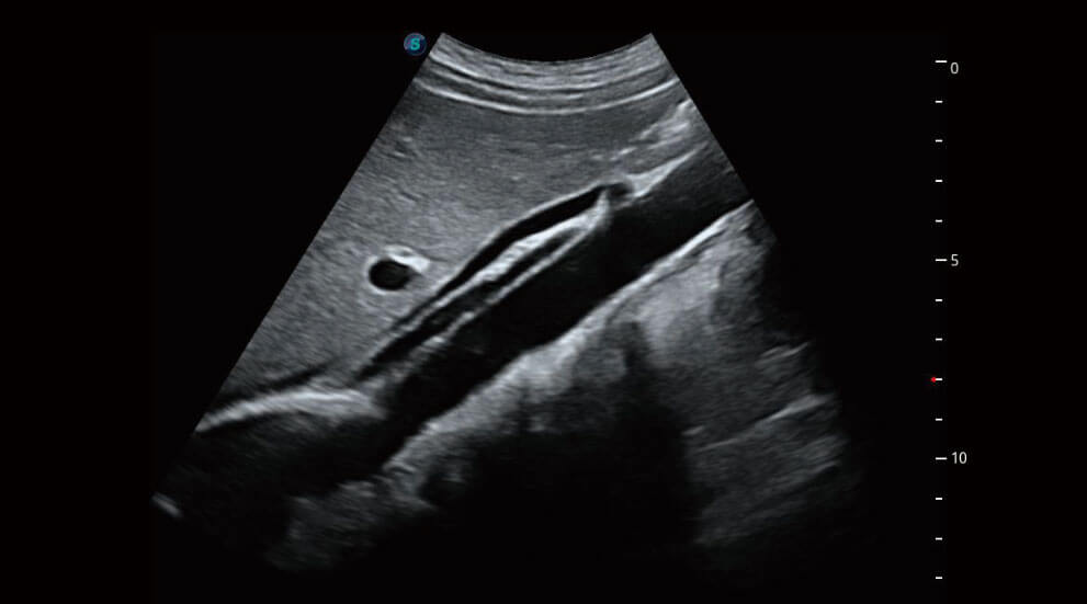 Máy siêu âm Sonoscape P50 Elite công nghệ 5D Slive Silhouette